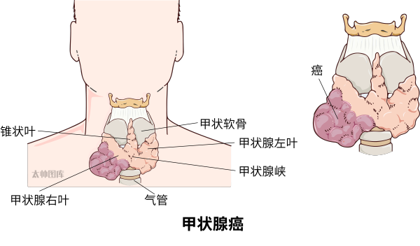 甲状腺癌(标注版) 医学插画