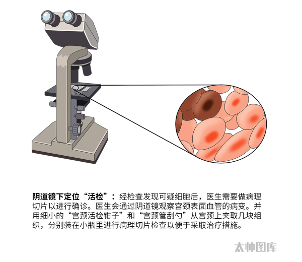 宫颈癌 医学插画