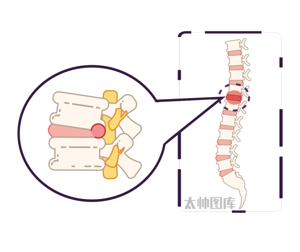 腰椎间盘突出 医学插画